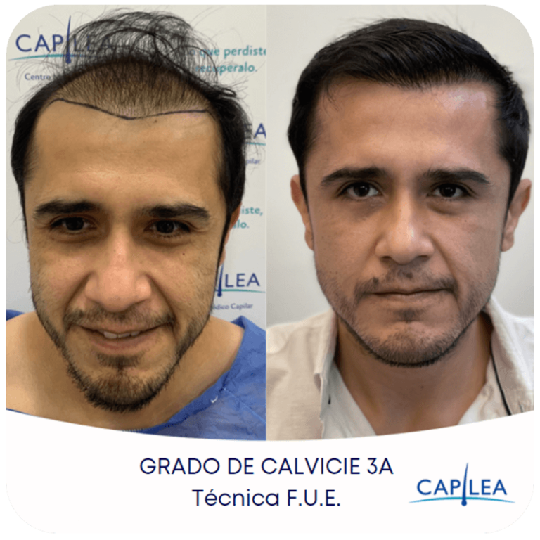 Injerto de Cabello ¿Cuánto cuesta en México? - Capilea México