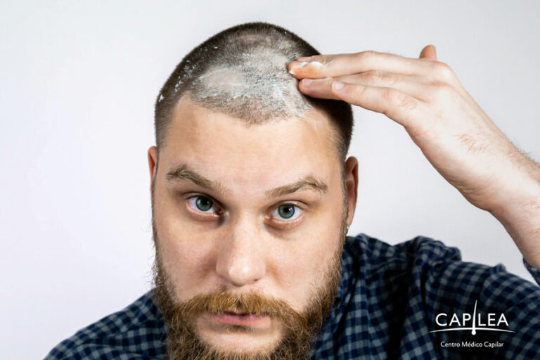 All you need to know about scabs after a hair transplant - Capilea México