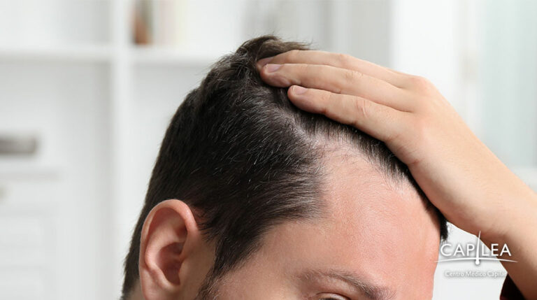 Cómo hacer crecer pelo en las entradas - Capilea México